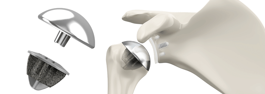 Total Shoulder Replacement - Dr. Edwin Spencer